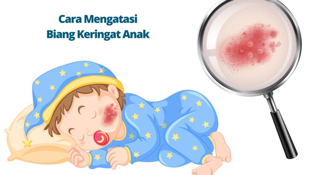 Cara Mengatasi Biang Keringat Anak - Primaya Hospital