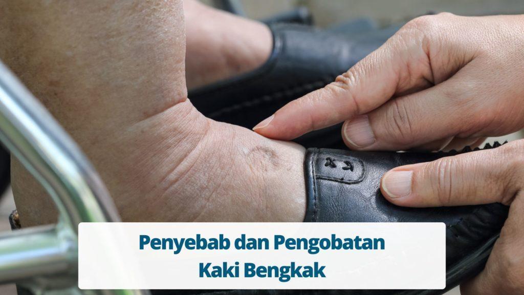 Kenali Penyebab Kaki Bengkak - Primaya Hospital